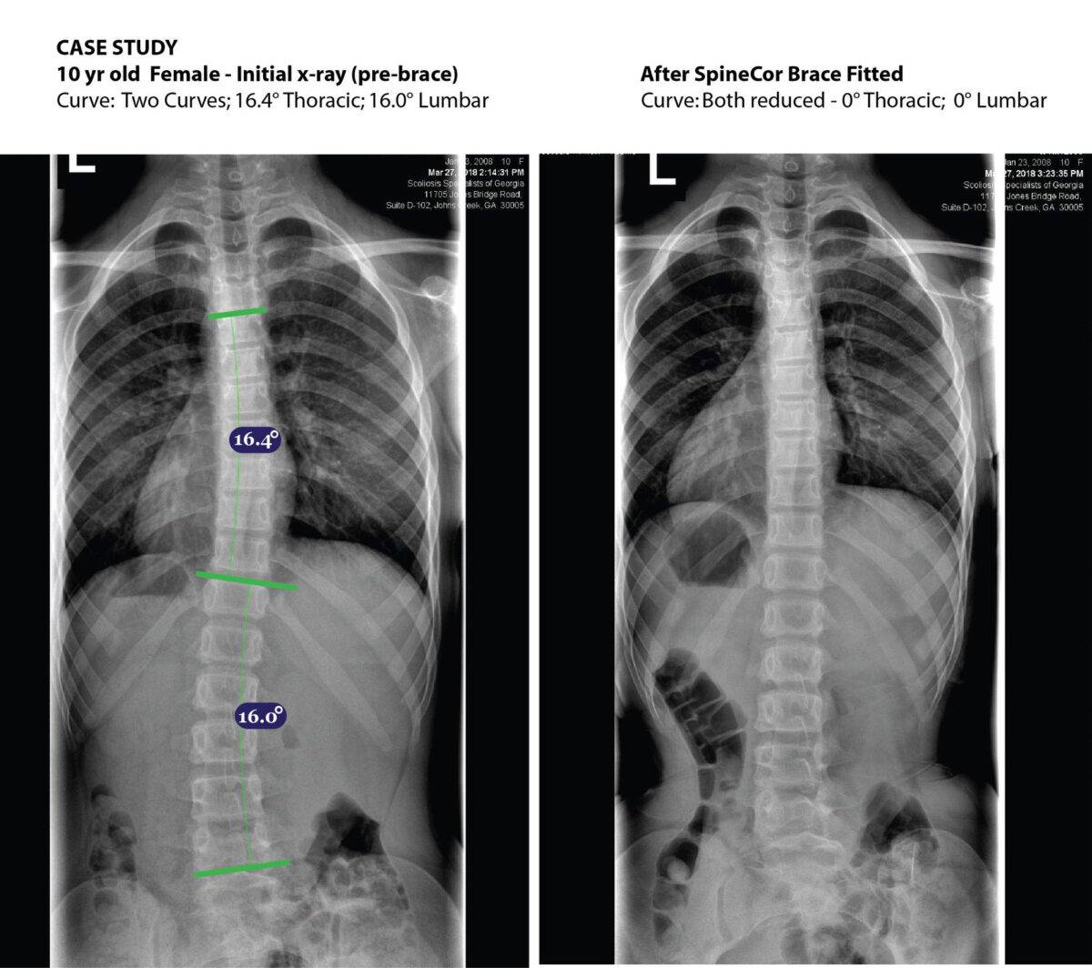 Home - Scoliosis Fix