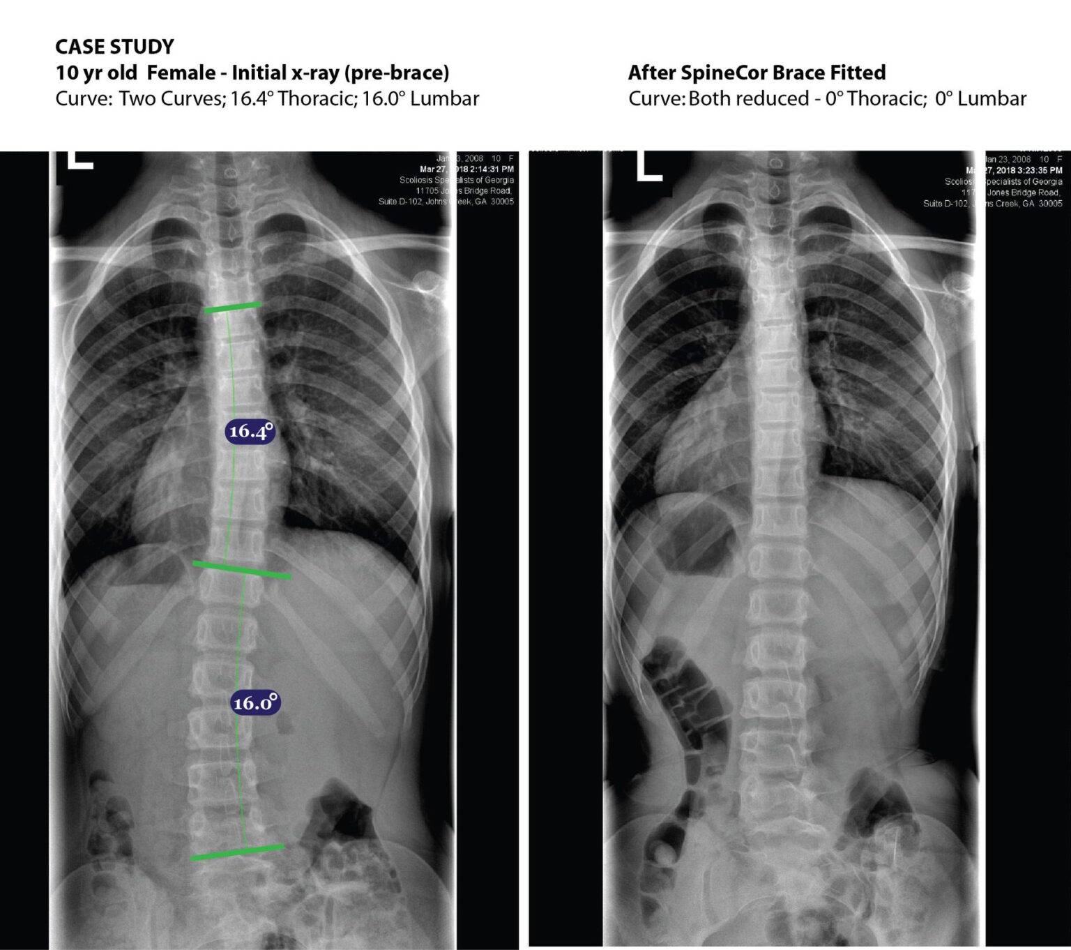 Home - Scoliosis Fix