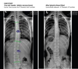 Home - Scoliosis Fix