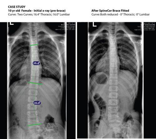 Home - Scoliosis Fix